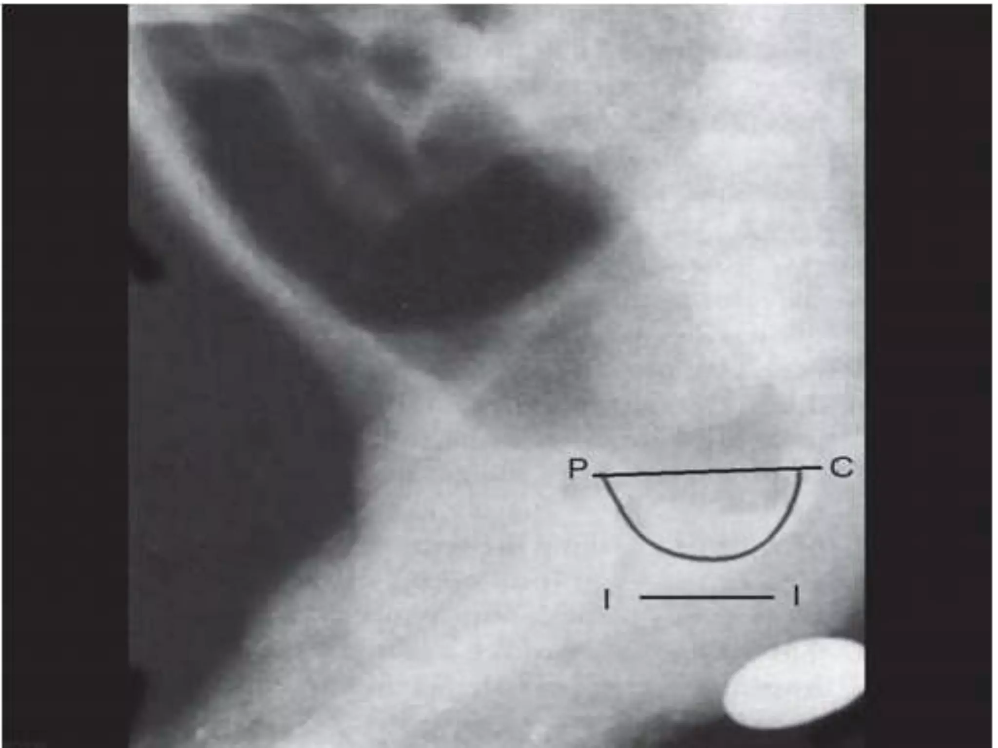 Invertogram ANORECTAL MALFORMATION ( ARM ) PRANAYA | PPTX