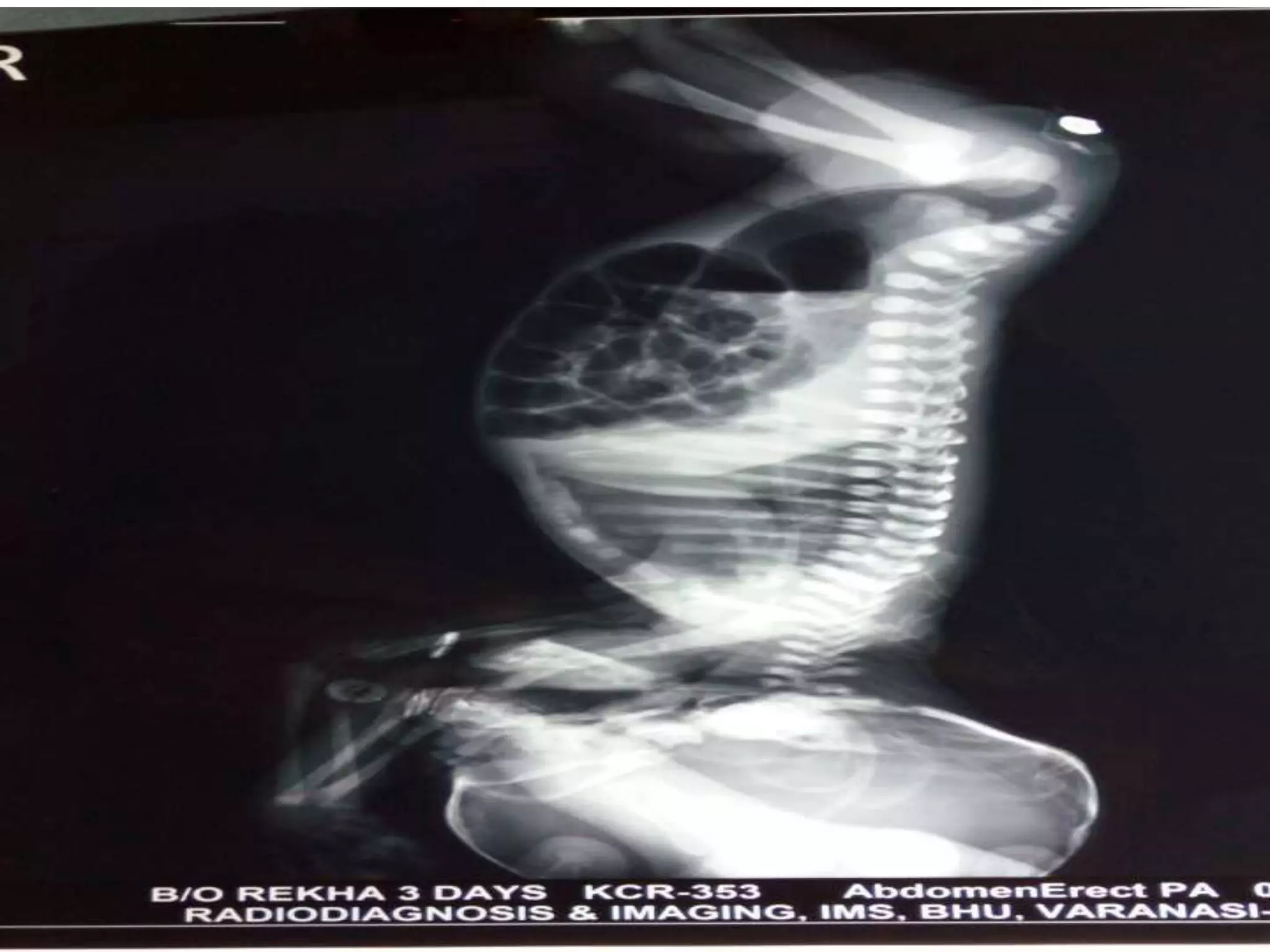 Invertogram ANORECTAL MALFORMATION ( ARM ) PRANAYA | PPTX