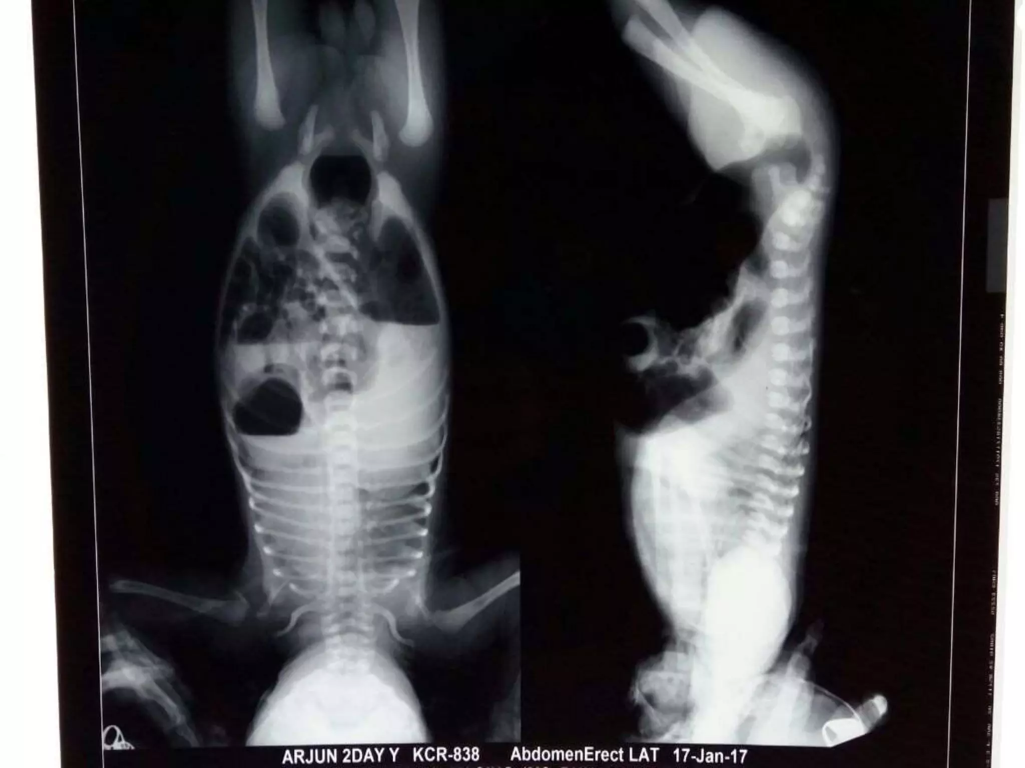 Invertogram ANORECTAL MALFORMATION ( ARM ) PRANAYA | PPTX