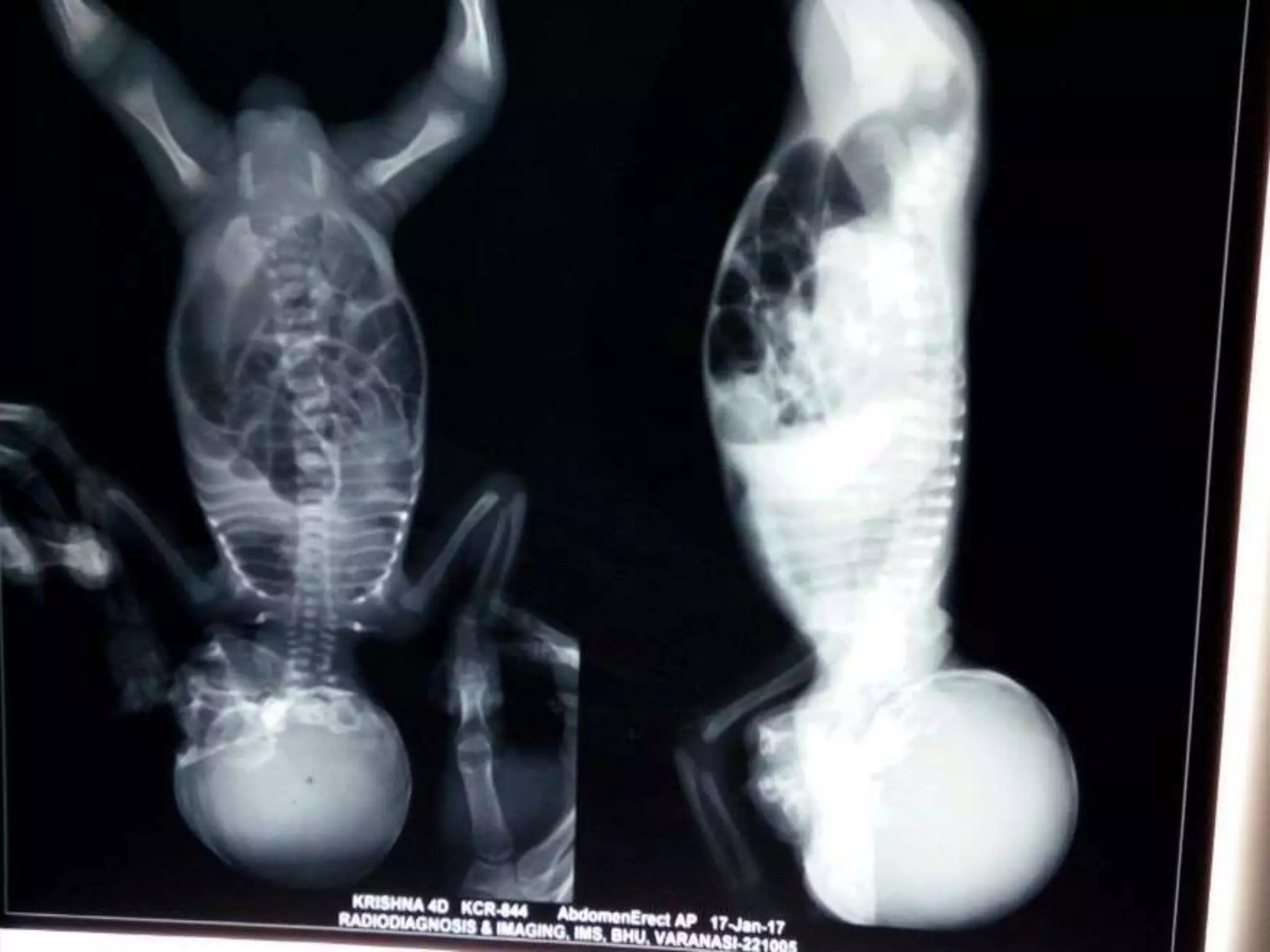 Invertogram ANORECTAL MALFORMATION ( ARM ) PRANAYA | PPTX | Pregnancy ...