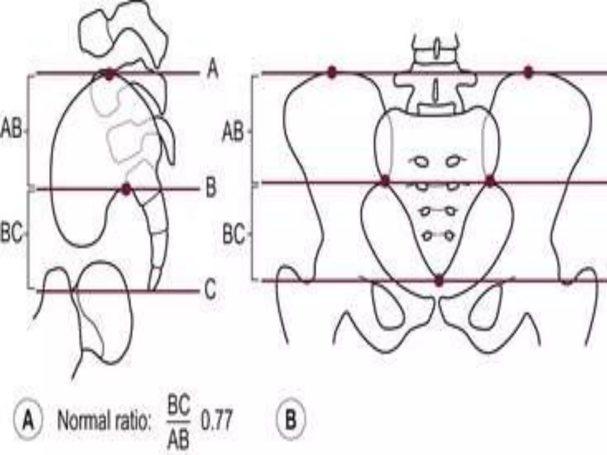 Invertogram ANORECTAL MALFORMATION ( ARM ) PRANAYA | PPTX
