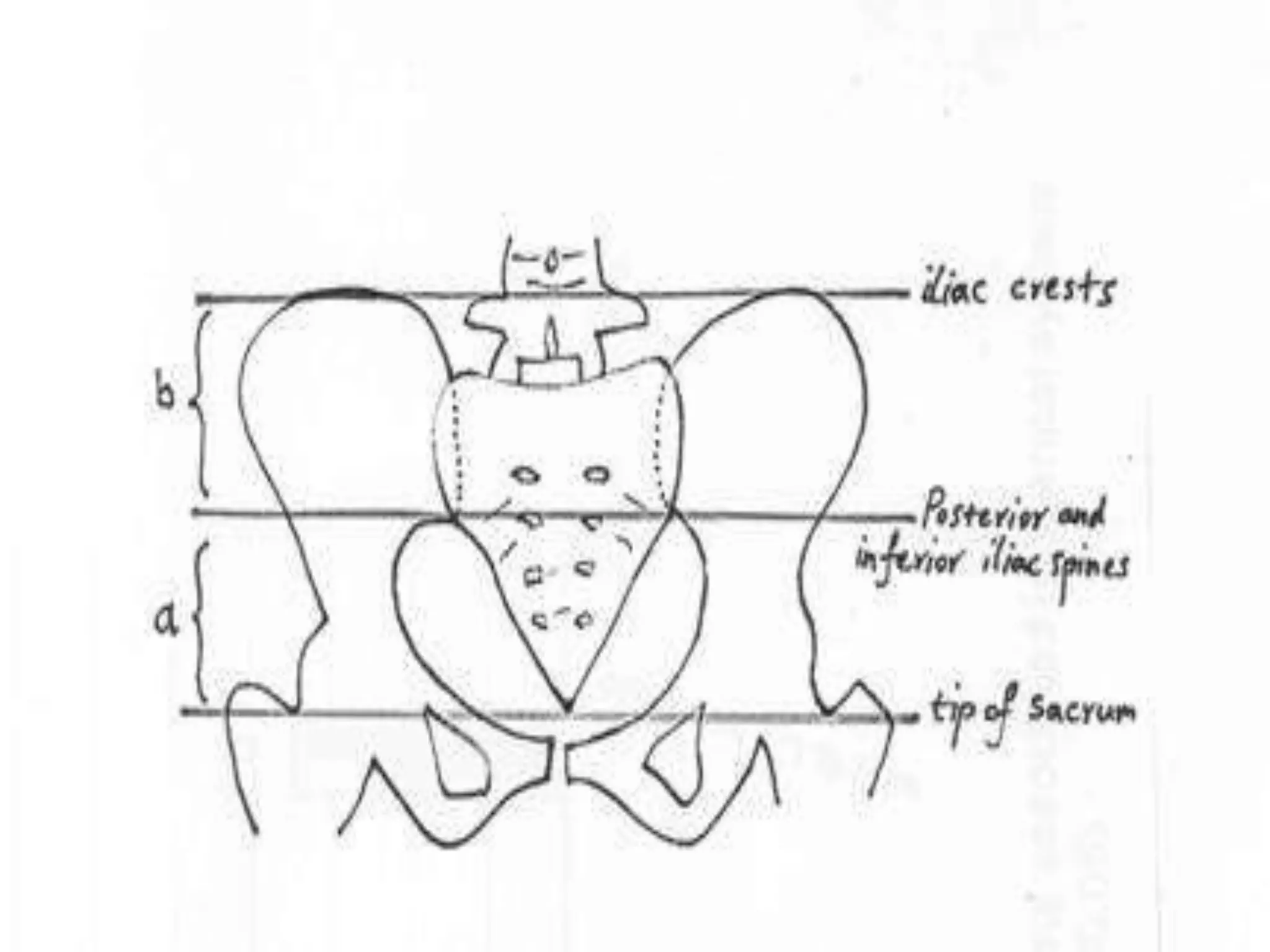 Invertogram ANORECTAL MALFORMATION ( ARM ) PRANAYA | PPTX