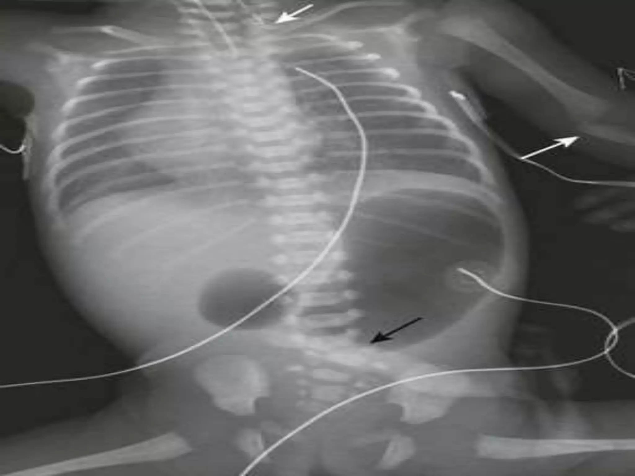 Invertogram ANORECTAL MALFORMATION ( ARM ) PRANAYA | PPTX