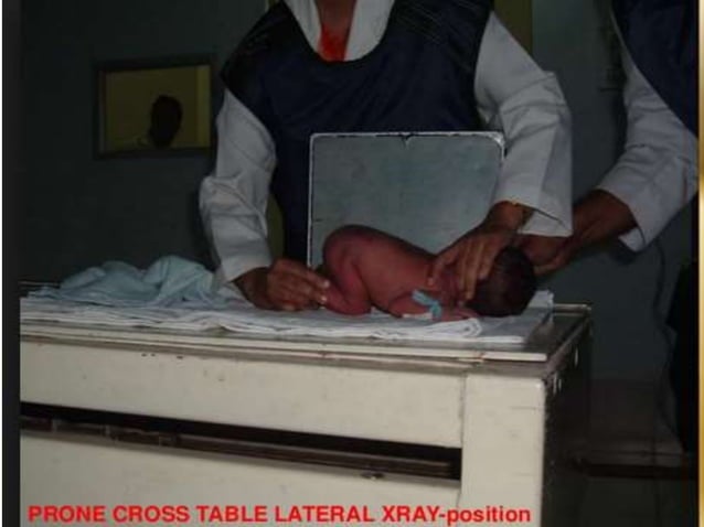 Invertogram ANORECTAL MALFORMATION ( ARM ) PRANAYA | PPTX | Pregnancy ...