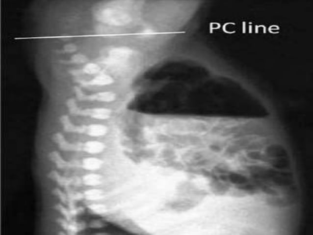 Invertogram ANORECTAL MALFORMATION ( ARM ) PRANAYA | PPTX | Pregnancy ...