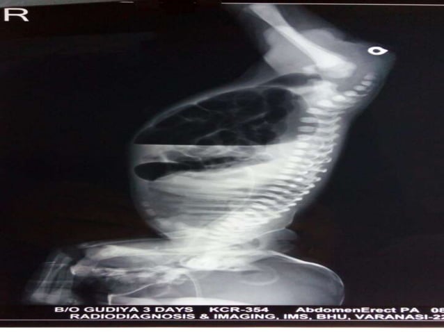 Invertogram ANORECTAL MALFORMATION ( ARM ) PRANAYA | PPTX | Pregnancy ...