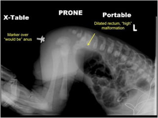 Invertogram ANORECTAL MALFORMATION ( ARM ) PRANAYA | PPTX