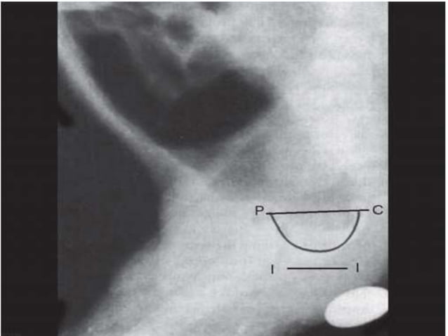 Invertogram ANORECTAL MALFORMATION ( ARM ) PRANAYA | PPTX | Pregnancy ...