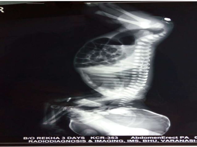 Invertogram ANORECTAL MALFORMATION ( ARM ) PRANAYA | PPTX | Pregnancy ...