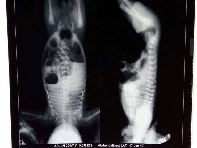 Invertogram ANORECTAL MALFORMATION ( ARM ) PRANAYA | PPTX | Pregnancy ...