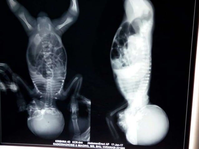 Invertogram ANORECTAL MALFORMATION ( ARM ) PRANAYA | PPTX | Pregnancy ...