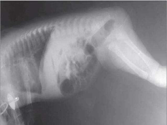 Invertogram ANORECTAL MALFORMATION ( ARM ) PRANAYA | PPTX | Pregnancy ...