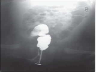 Invertogram ANORECTAL MALFORMATION ( ARM ) PRANAYA | PPTX