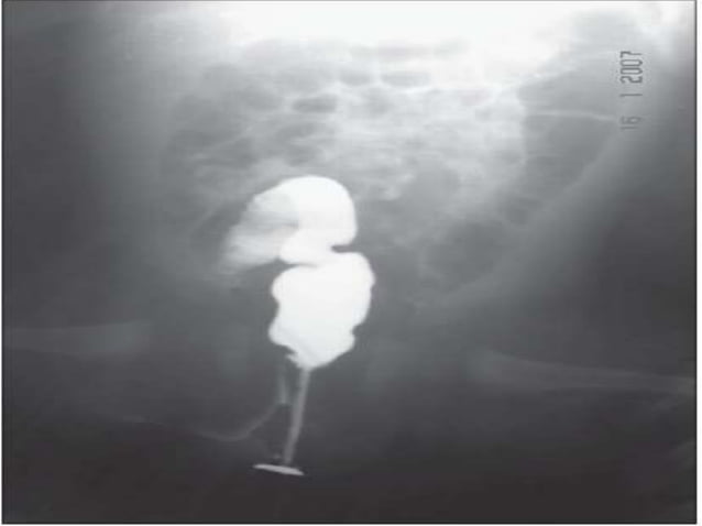 Invertogram ANORECTAL MALFORMATION ( ARM ) PRANAYA | PPTX | Pregnancy ...