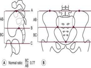 Invertogram ANORECTAL MALFORMATION ( ARM ) PRANAYA | PPTX
