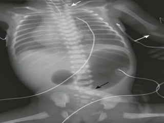 Invertogram ANORECTAL MALFORMATION ( ARM ) PRANAYA | PPTX