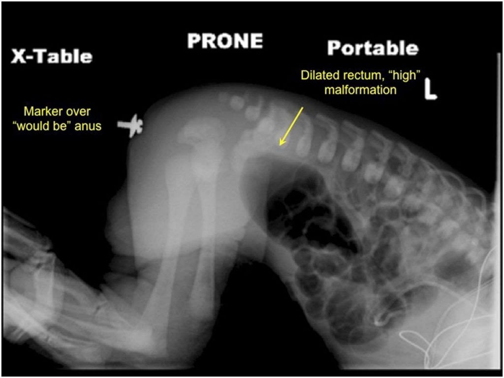 Invertogram ANORECTAL MALFORMATION ( ARM ) PRANAYA