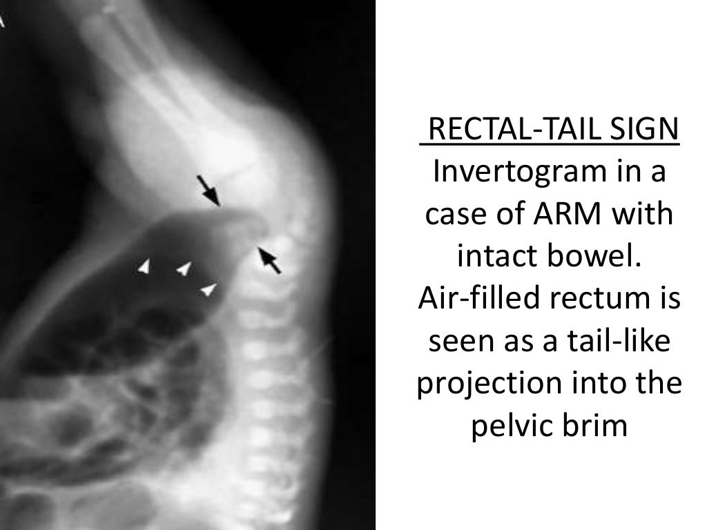 Invertogram ANORECTAL MALFORMATION ( ARM ) PRANAYA