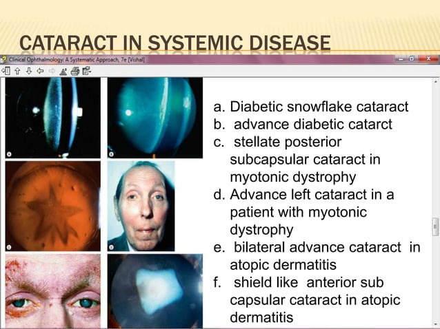 Investigation and management of senile cataract | PPTX