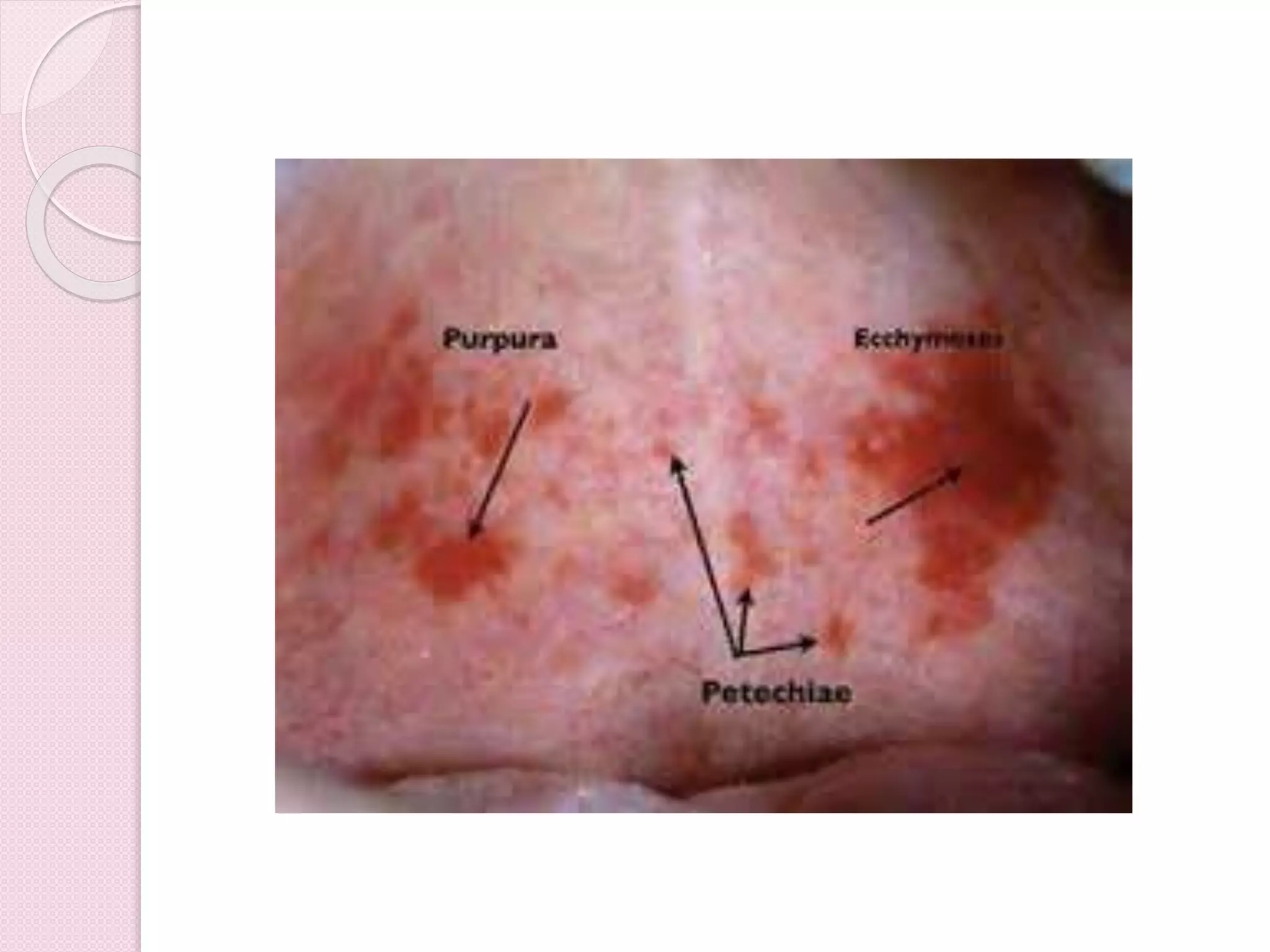 Investigation of purpuric rash | PPTX
