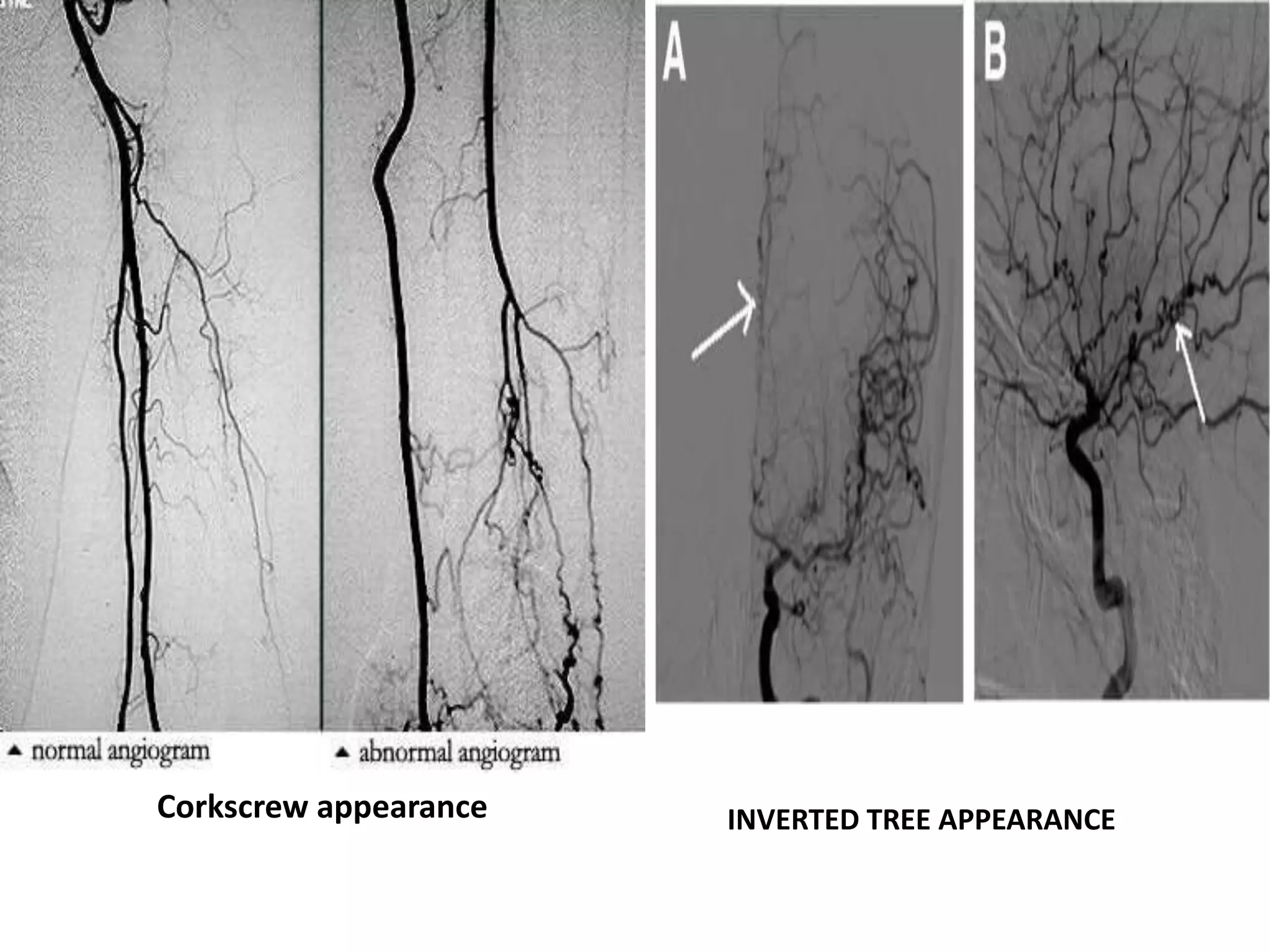 THROMBOANGIITIS OBLITERANS- INVESTIGATIONS(SURGERY) | PPTX | Heart and ...