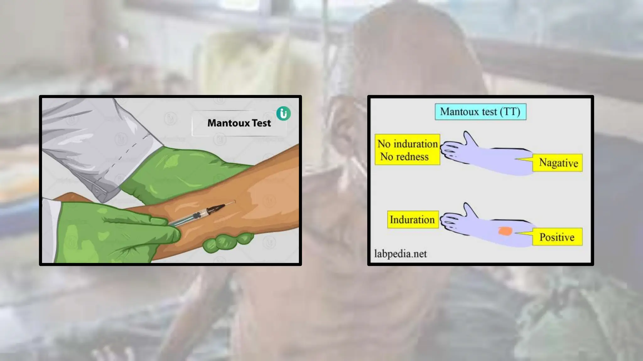 INVESTIGATIONS AND TREATMENT OF TUBERCULOSIS.pptx