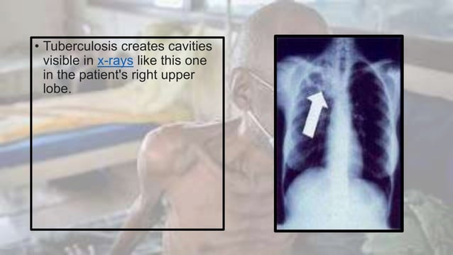 INVESTIGATIONS AND TREATMENT OF TUBERCULOSIS.pptx