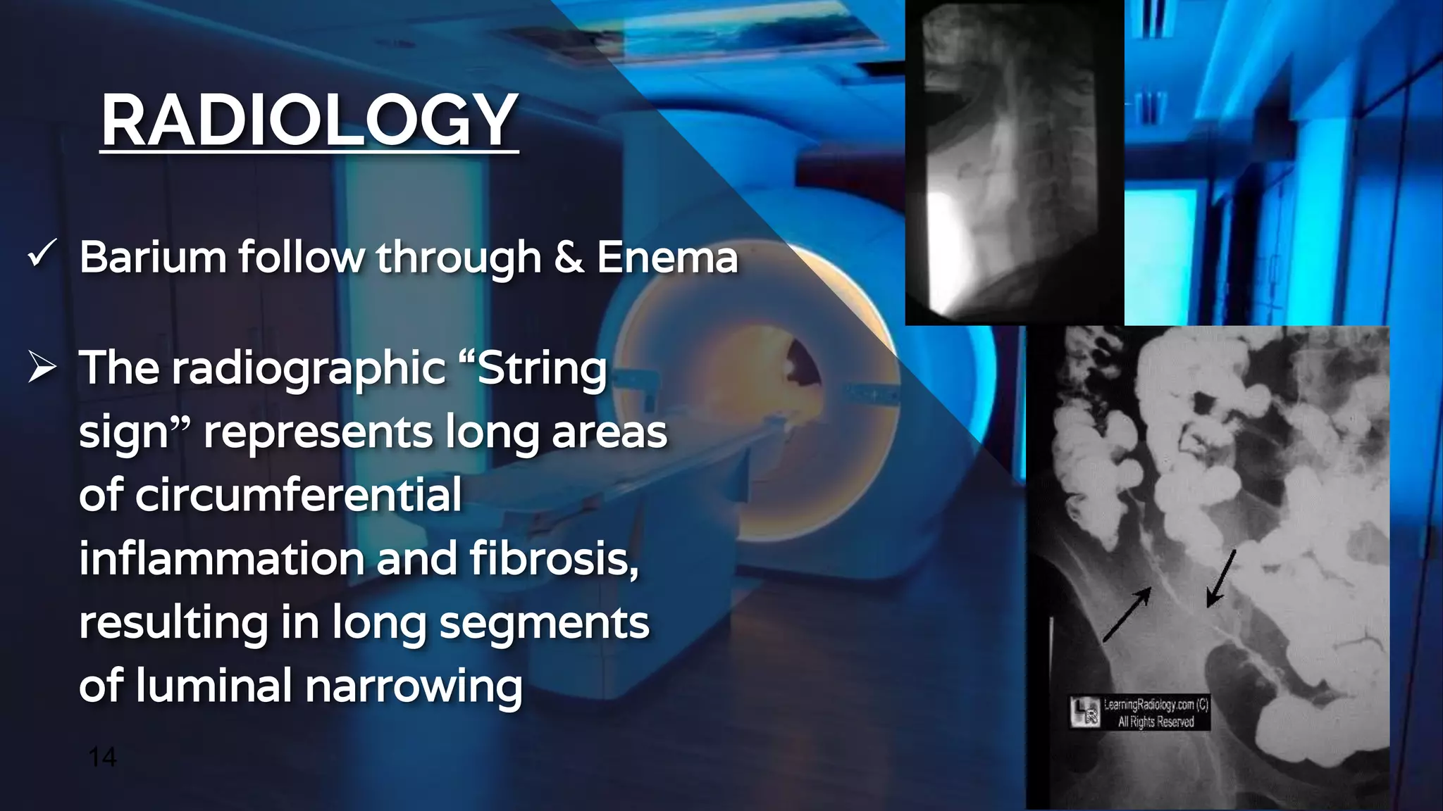 Investigations CROHNS Disease.pptx