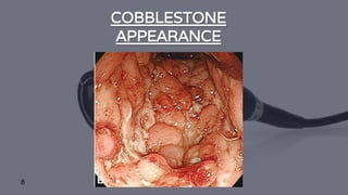 Investigations CROHNS Disease.pptx
