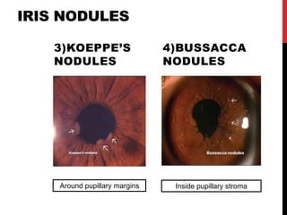INVESTIGATIONS FOR UVEAL TRACT DISEASES.pptx