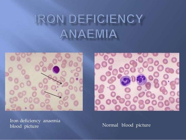 Investigations in diagnosing type and causes of anaemia