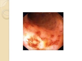 Investigations in lower gastrointestinal bleed | PPTX