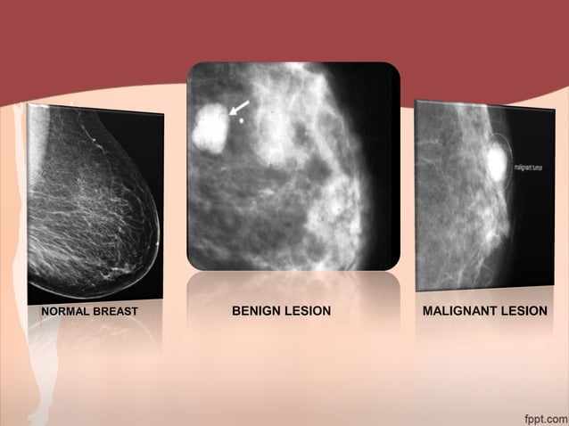 Investigations of ca breast | PPT | Cancer | Diseases and Conditions