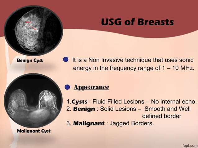 Investigations of ca breast | PPT | Cancer | Diseases and Conditions