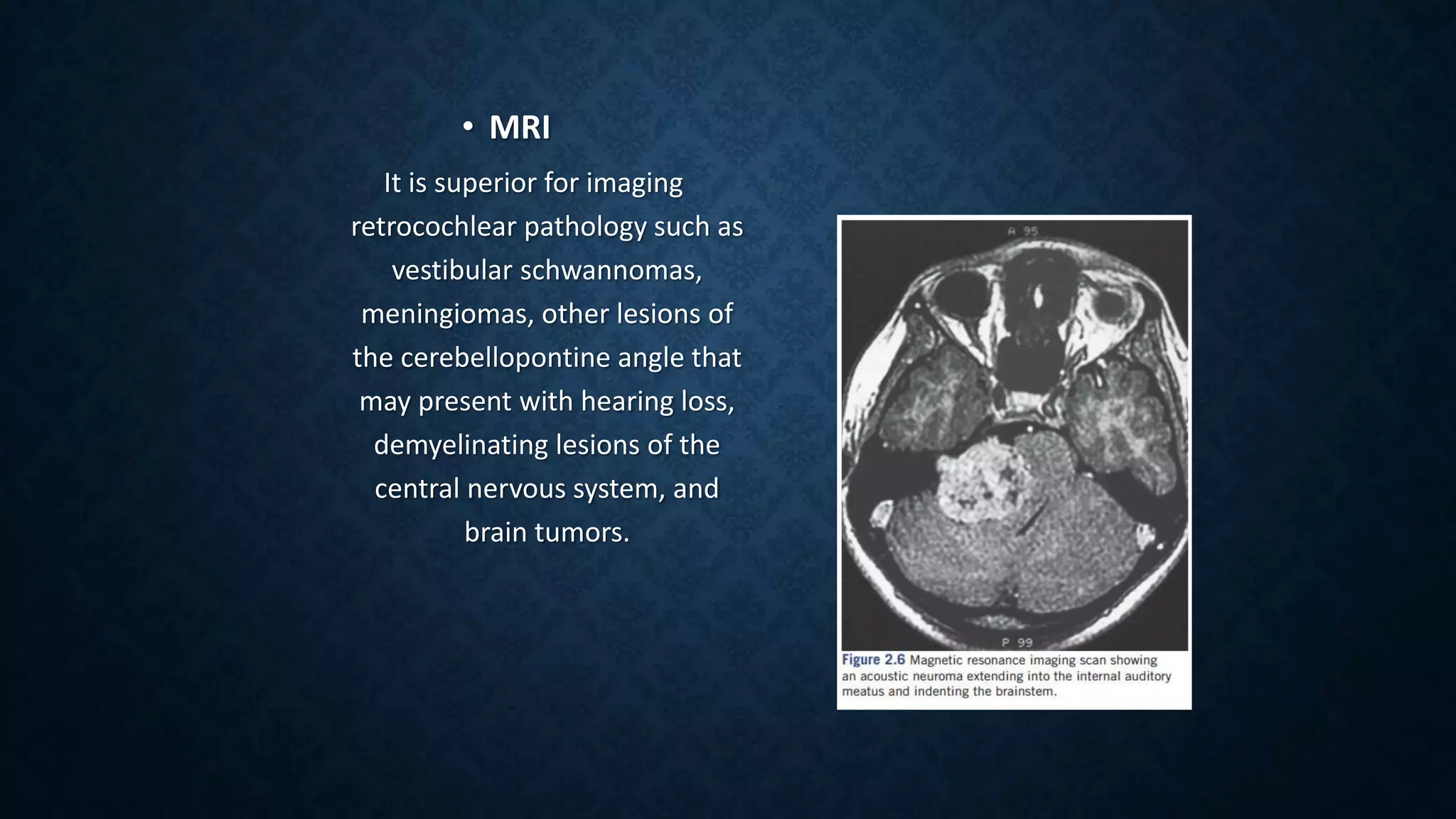 Investigations of Sensorineural hearing loss (SNHL) | PPTX