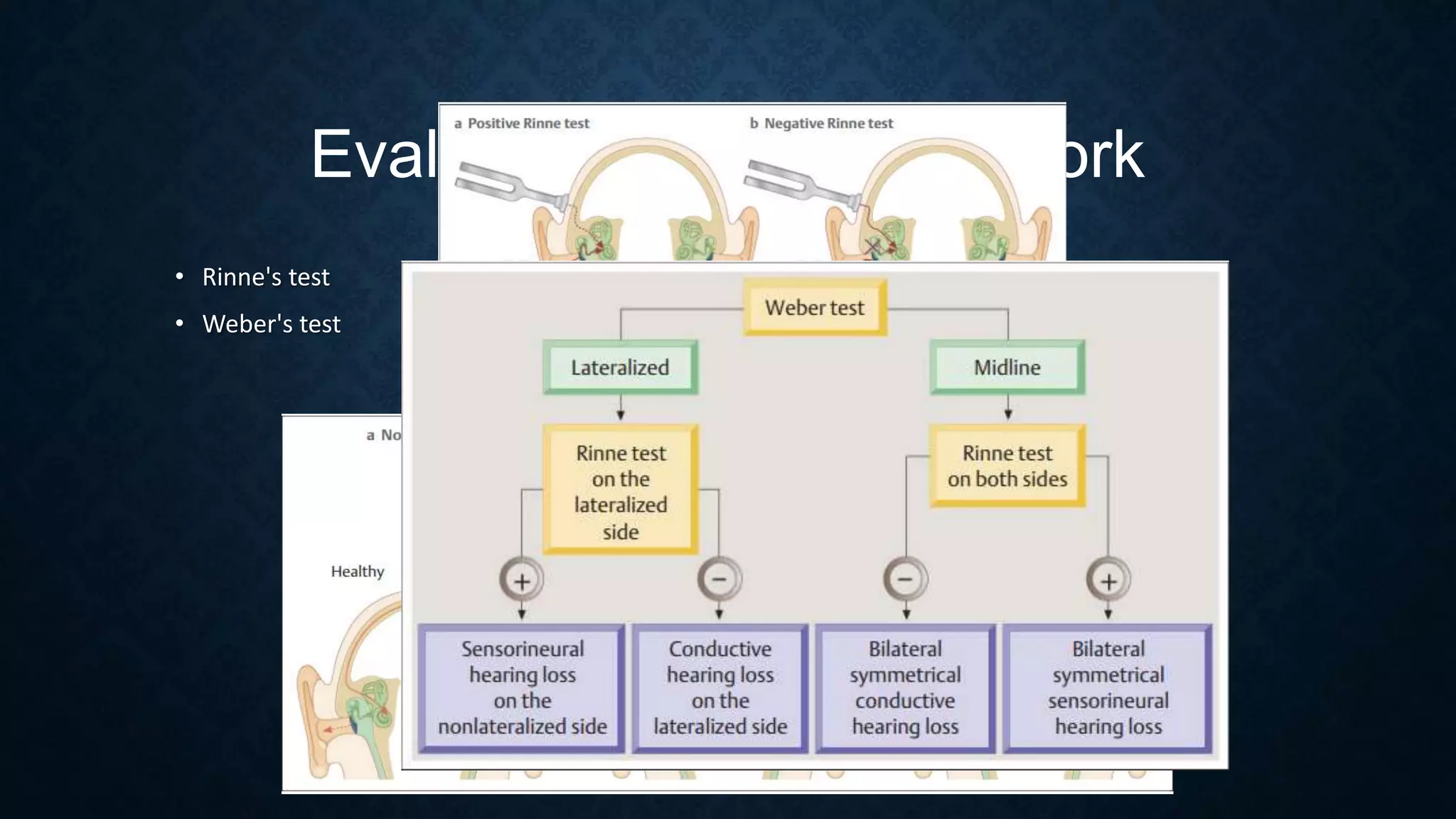 Investigations of Sensorineural hearing loss (SNHL) | PPTX