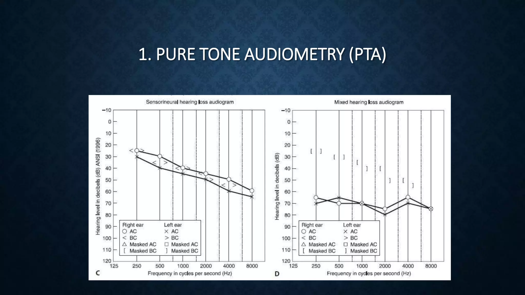 Investigations of Sensorineural hearing loss (SNHL) | PPTX