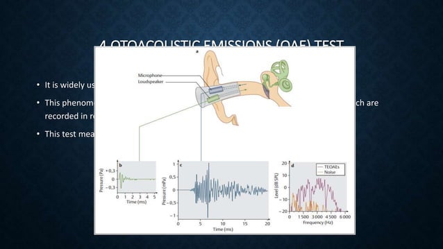 Investigations of Sensorineural hearing loss (SNHL) | PPTX | Ear, Nose ...
