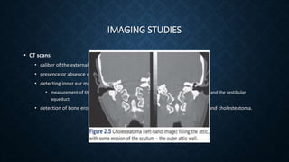 Investigations of Sensorineural hearing loss (SNHL) | PPTX