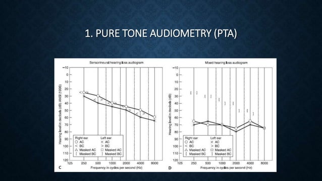 Investigations of Sensorineural hearing loss (SNHL) | PPTX | Ear, Nose ...