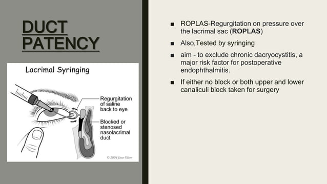 Investigations required for cataract evaluation | PPT