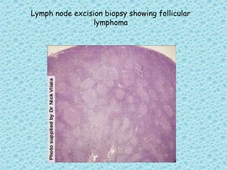 Investigation to do in a case of lymphadenopathy | PPT