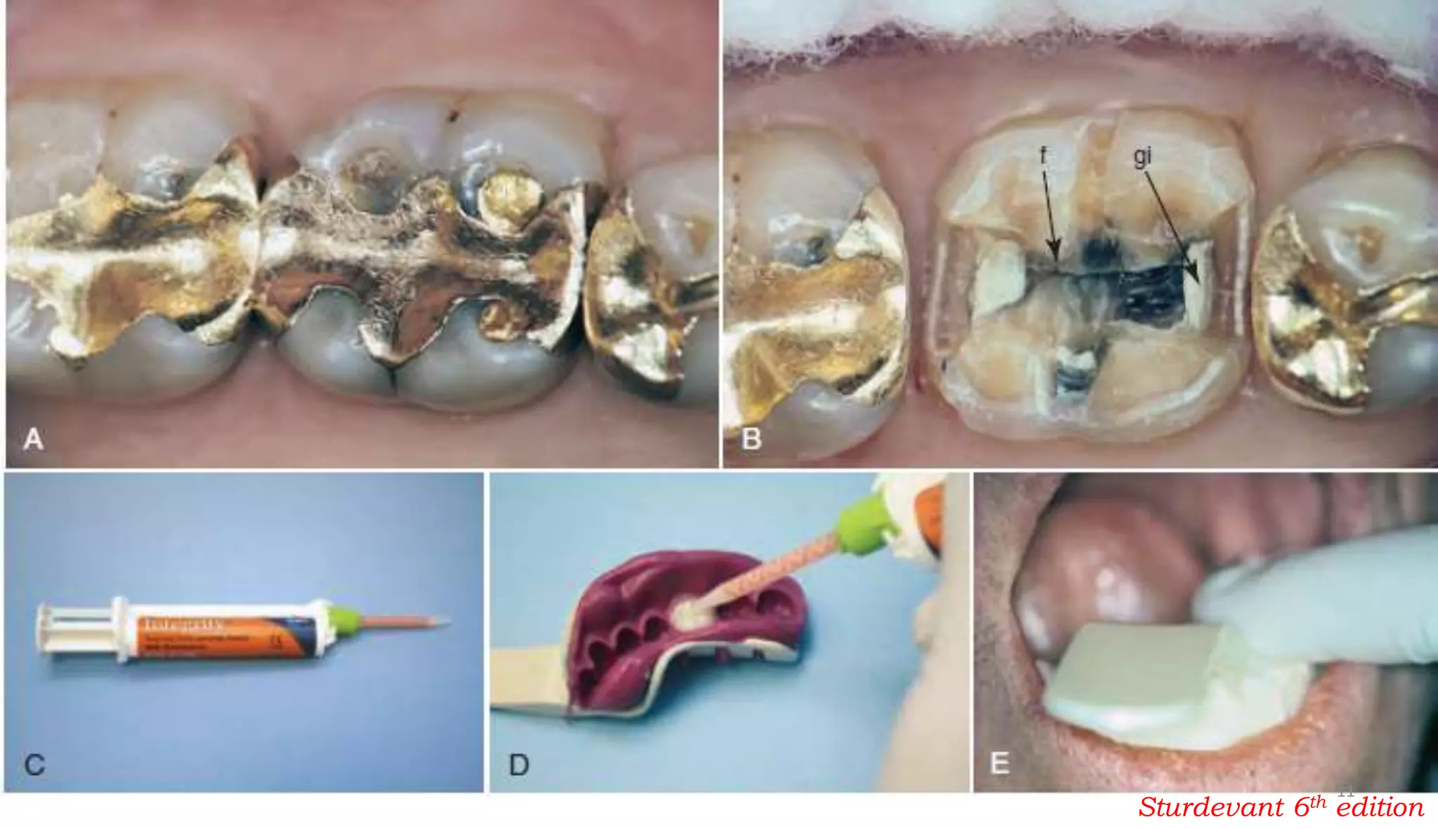 CEMENTATION OF INLAY AND VARIOUS TECHNIQUE FOR TEMPORIZATION | PPTX