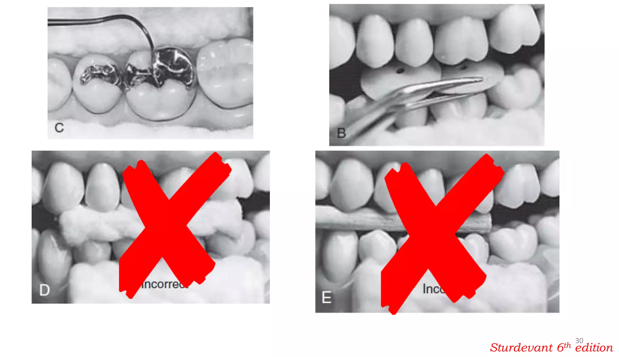 CEMENTATION OF INLAY AND VARIOUS TECHNIQUE FOR TEMPORIZATION | PPTX