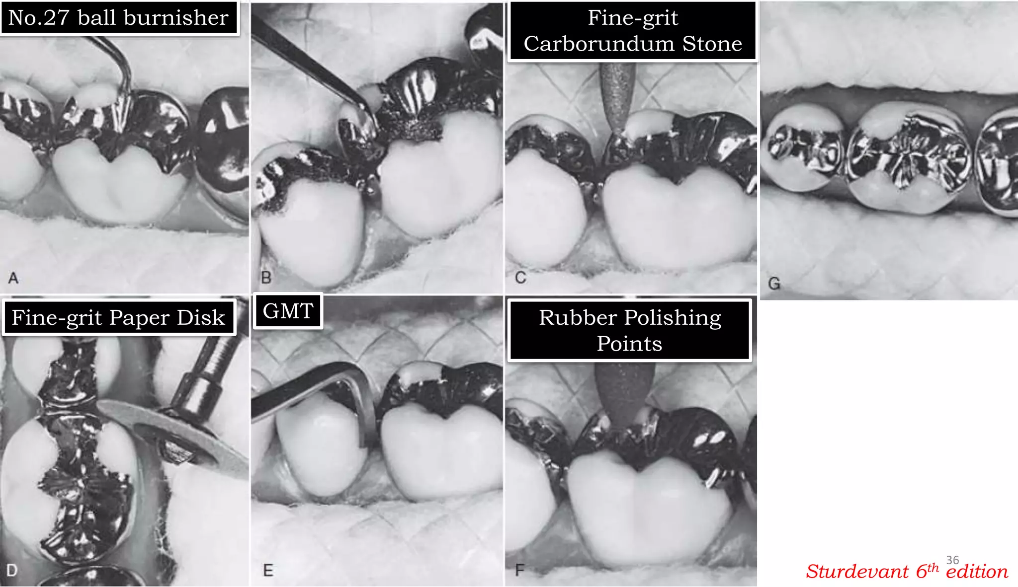 CEMENTATION OF INLAY AND VARIOUS TECHNIQUE FOR TEMPORIZATION | PPTX