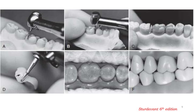 CEMENTATION OF INLAY AND VARIOUS TECHNIQUE FOR TEMPORIZATION | PPTX