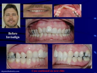 Invisalign | PPT