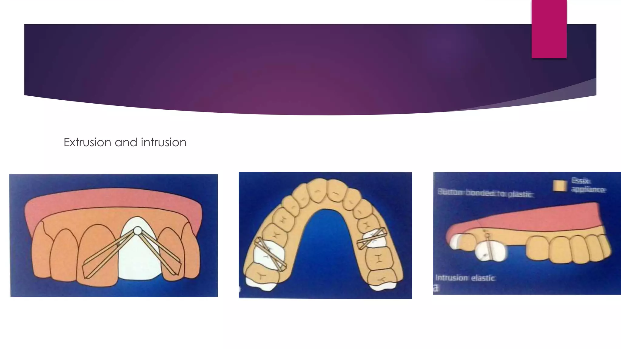 Invisalign | PPTX