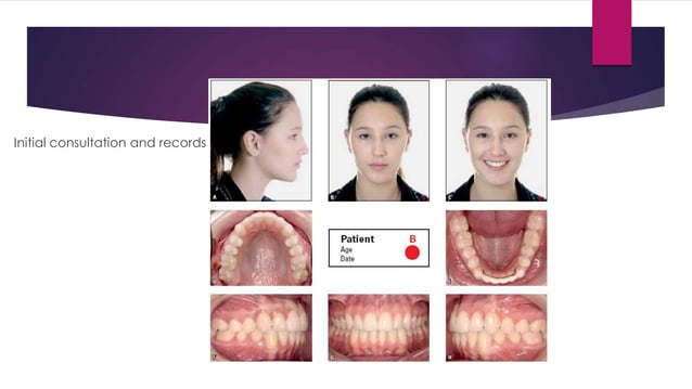 Invisalign | PPTX | Dental Health | Diseases and Conditions