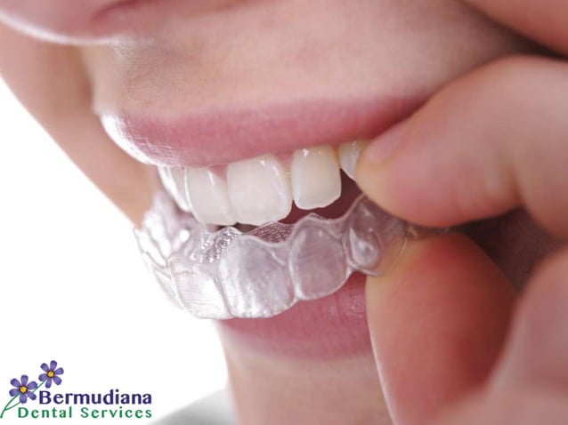 All about INVISALIGN | PPTX | Dental Health | Diseases and Conditions
